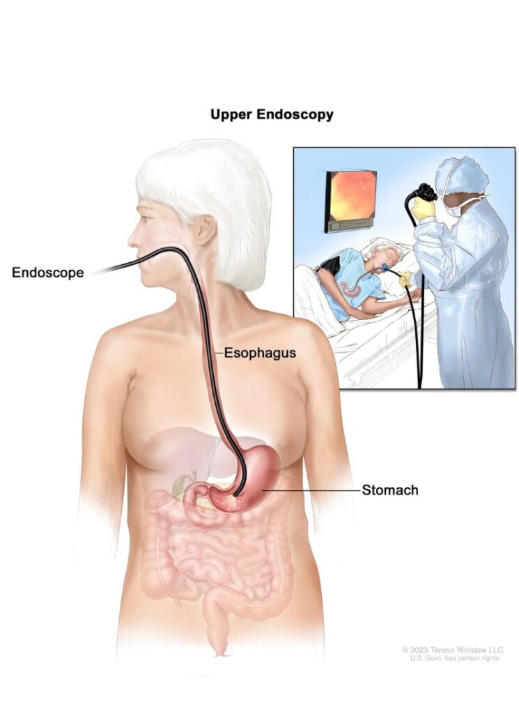 Upper GI endoscopy – Gastroworld Clinic Health Treatment
